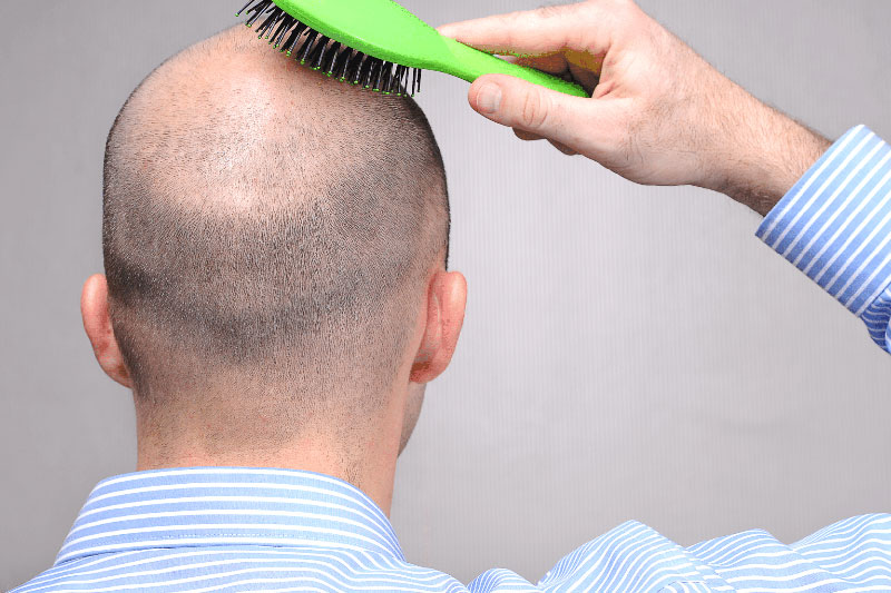 Ουλωτική Αλωπεκία - Dermagen Clinic